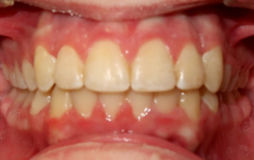 Braces & Invisalign Before and After Results | TDR Orthodontics