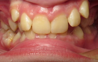 Braces & Invisalign Before and After Results | TDR Orthodontics